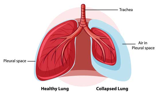 Recovery From A Collapsed Lung – EMXVRB