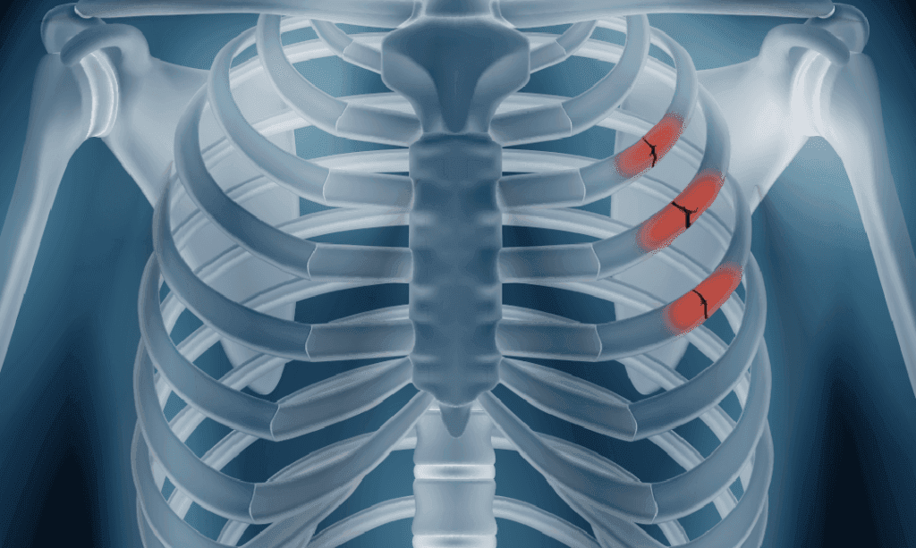Understanding Rib Fractures - Mr. Marco Scarci